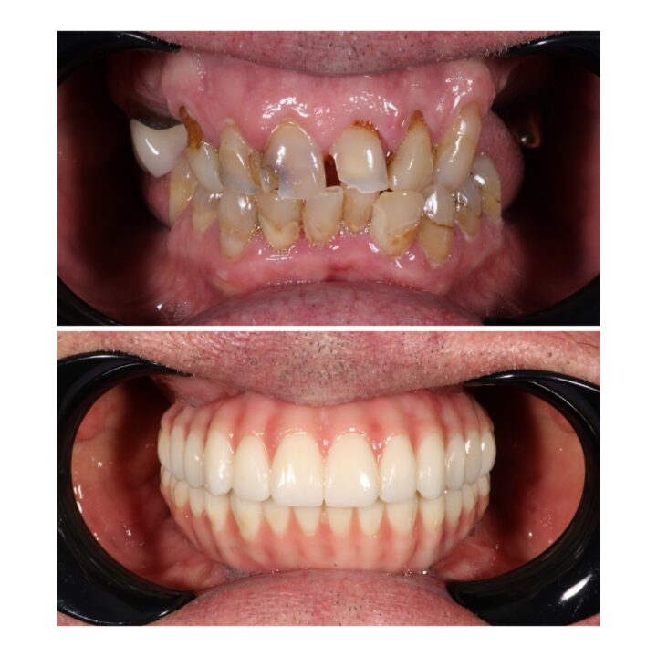 Patient Success Stories - Premier Oral Surgery & Implantology Center ...